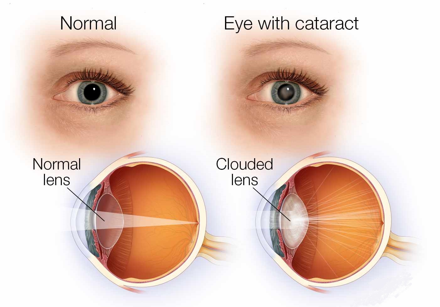 Cataracts in Children – Restore Foundation for Child Sight