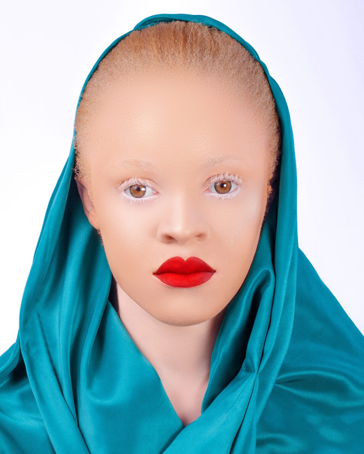 Albinism & The Eye – Restore Foundation for Child Sight