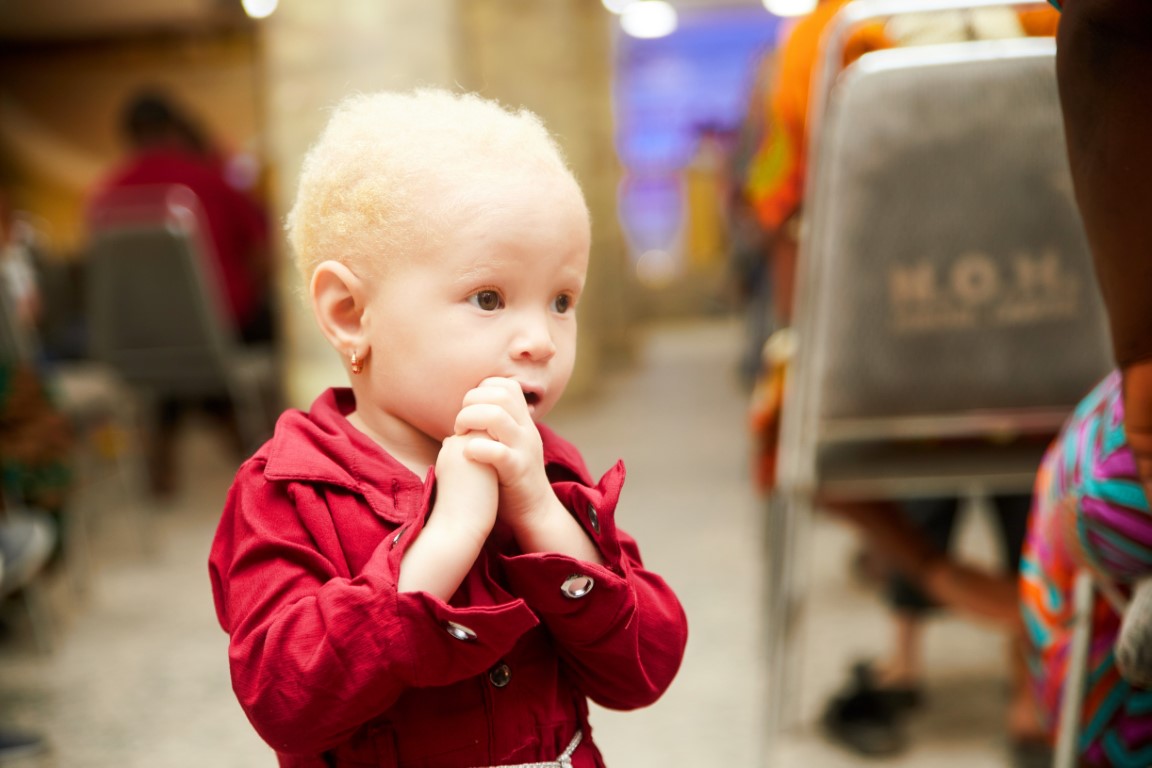 Albinism – Restore Foundation for Child Sight